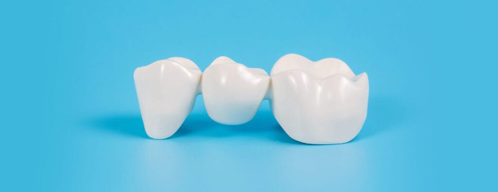 Porcelain Bridges in Gahanna and Columbus FAQ - The Smile Method